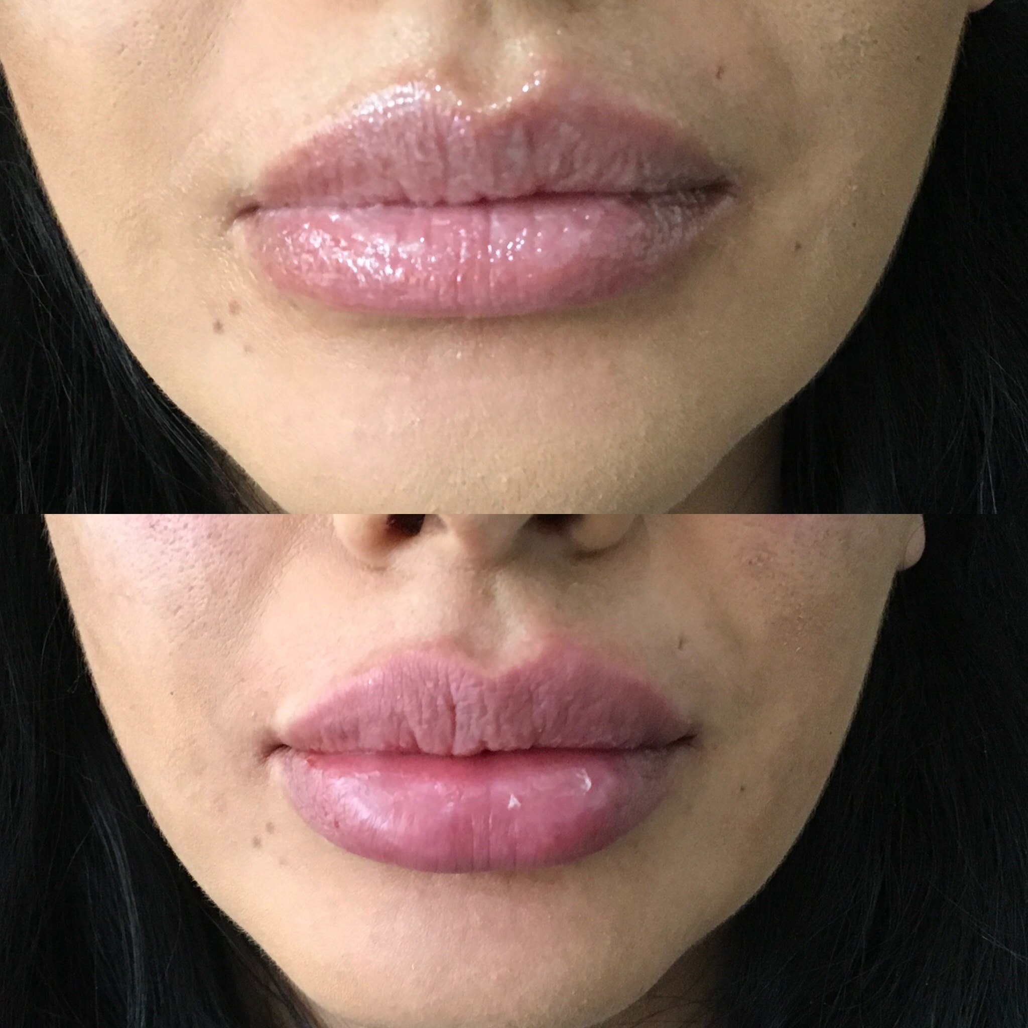 Juvederm Rellenos y Aumento de Labios- Vive Medical Spa